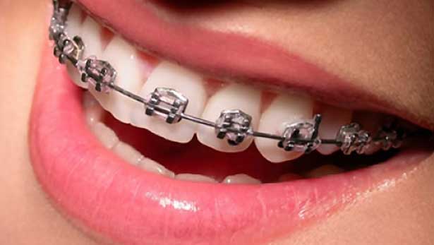 Aparelho-Autoligado-Metálico | Clínica Odontológica | Ortozen