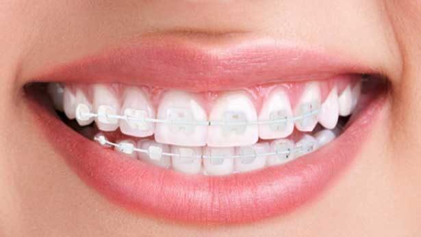 APARELHO AUTOLIGADO ESTÉTICO CERÂMICO EM CURITIBA E SÃO JOSÉ DOS ...